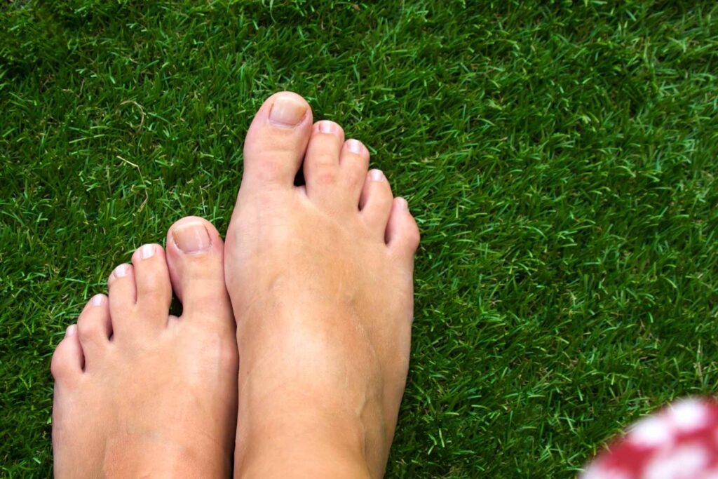 Webbed Toes Causes And Treatments Canyon Oaks Podiatrist In Visalia